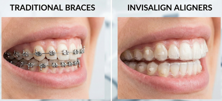 Invisalign vs Traditional Braces: Pros, Cons, Cost - Dentist Explained